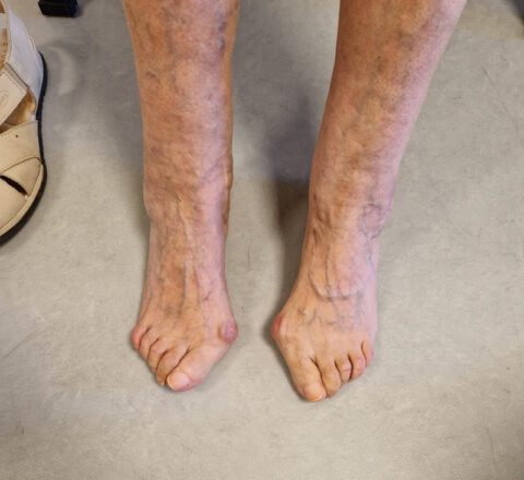 Les déformations de l’avant-pied