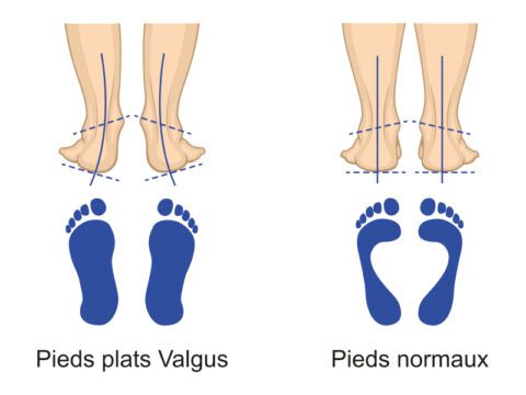 Pieds plats valgus : agir pour vontre confort